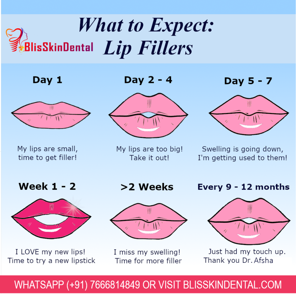 What to Expect When Getting Dermal Fillers - Dr Afsha Haji